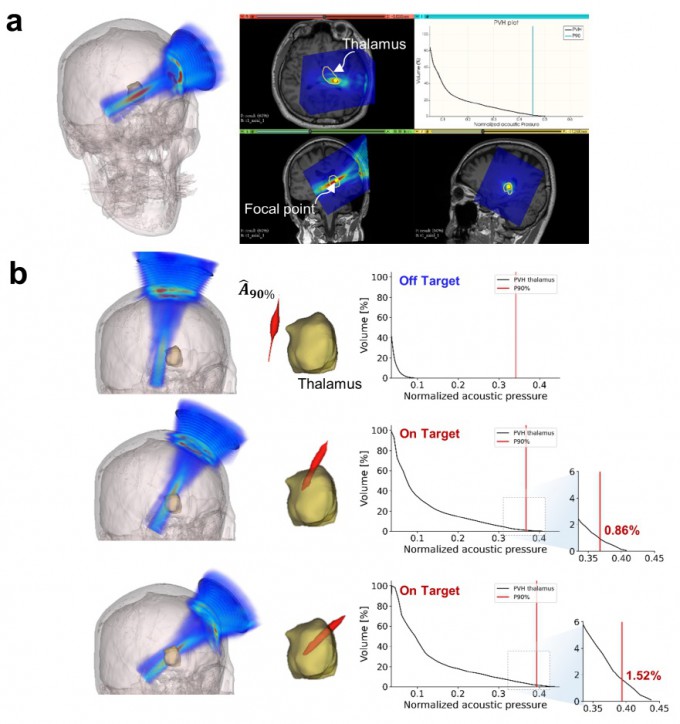 Breakthrough AI Enables Real-Time Focus Adjustment for Ultrasound Brain ...