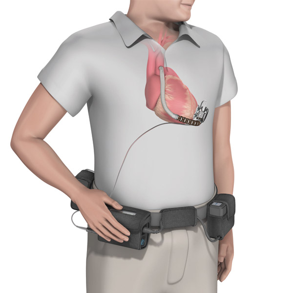 Woman Regains Health After 20 Years with Heart Transplant Following 3.5 ...